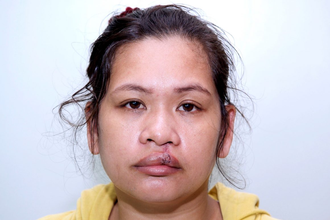 Cleft Lip & Cleft Palate – Manila, Philippines – Alliance for Smiles